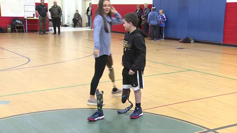 ‘There’s no limits’: 9-year-old athlete fitted with new prosthetic leg ...