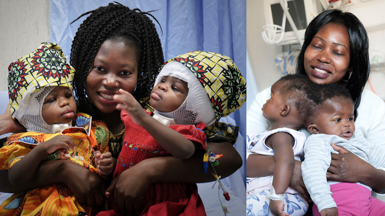 Twins joined at head separated at Vatican pediatric hospital - Boston ...