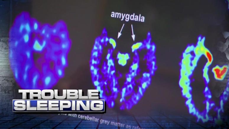 Boston University researchers discover link between CTE and severe ...