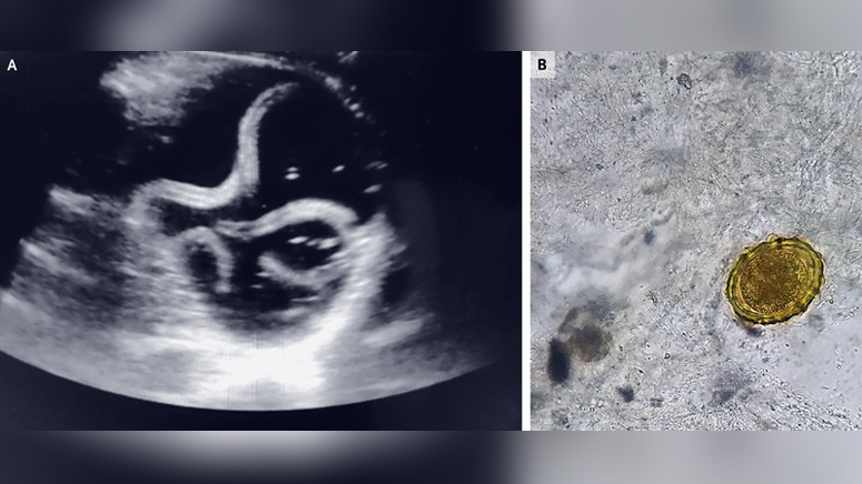 Medical examination shows parasites moving around in man’s stomach ...