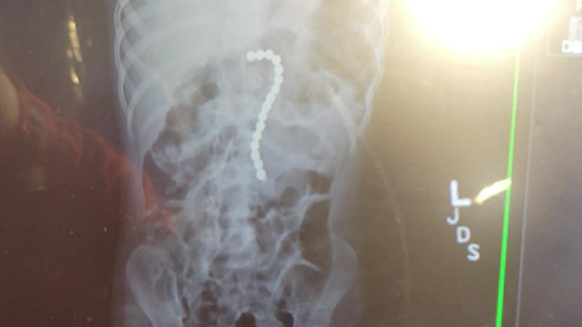 Toddler hospitalized after reportedly swallowing 16 magnetic balls ... Toddler hospitalized after reportedly swallowing 16 magnetic balls ...