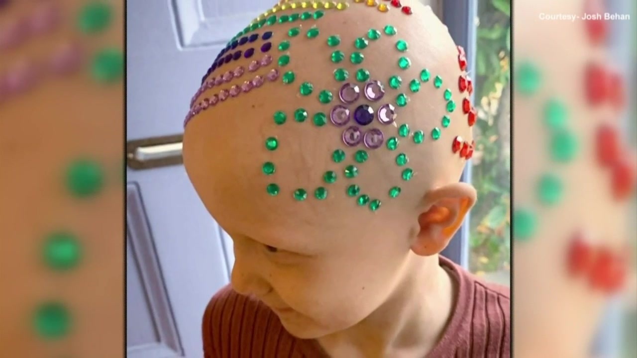 Parents help young girl without hair participate in ‘Crazy Hair Day’ by ...