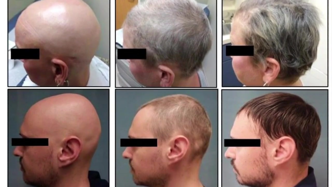 Lexington-based pharmaceutical company developing alopecia treatment ...