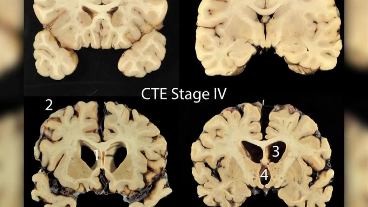 Boston University researchers confirm the first case of CTE in a former ...