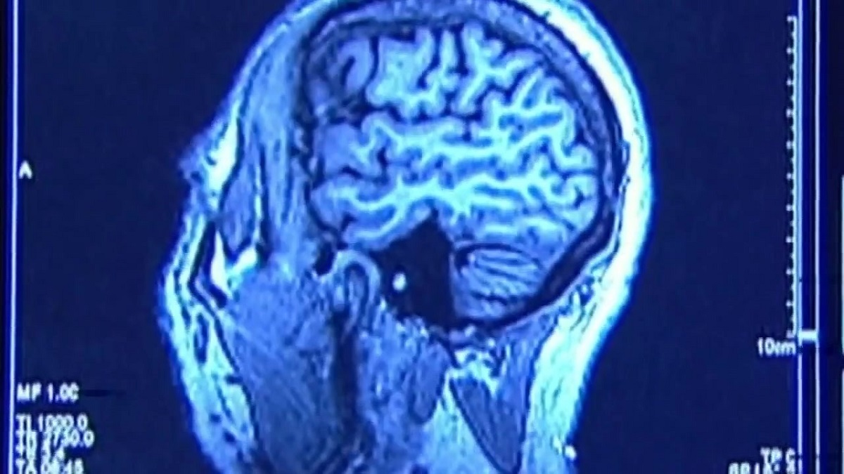 Alzheimer’s drug gets FDA panel’s backing, setting the stage for ...